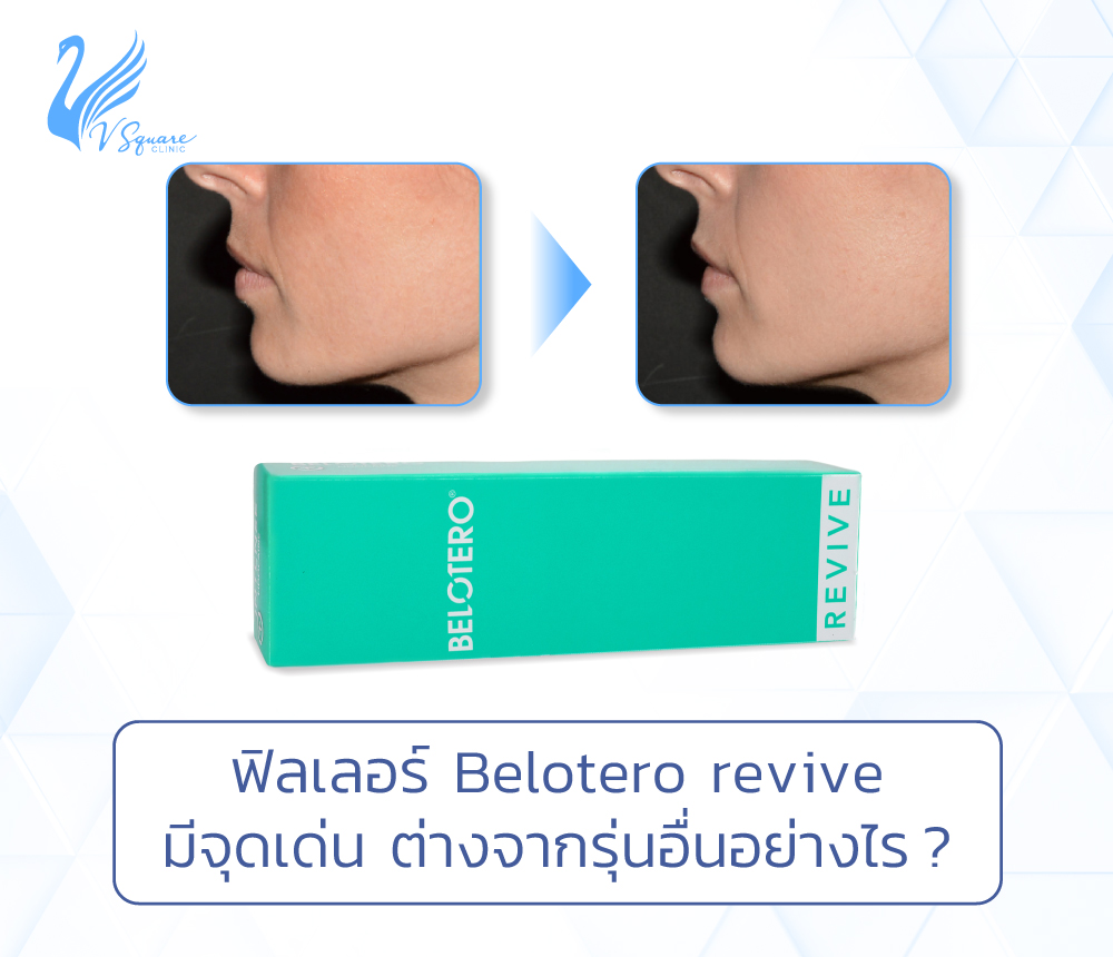 Belotero revive ฟิลเลอร์ HA+Glycerol มีจุดเด่นอย่างไร ? ช่วยอะไรบ้าง