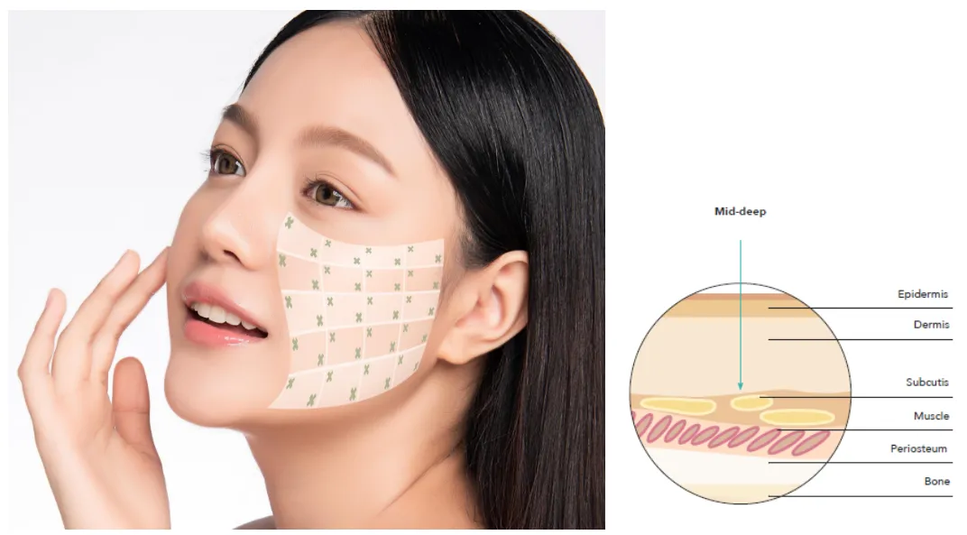 Belotero revive ฟิลเลอร์ HA+Glycerol มีจุดเด่นอย่างไร ? ช่วยอะไรบ้าง