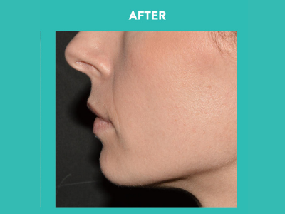 Belotero revive ฟิลเลอร์ HA+Glycerol มีจุดเด่นอย่างไร ? ช่วยอะไรบ้าง